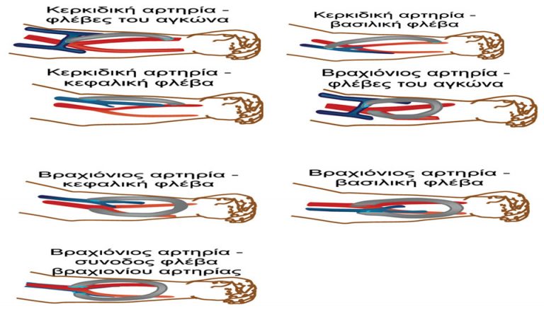 Αγγειακή προσπέλαση - Αγγειοχειρουργικό Κέντρο | Ιωάννης Κωτσικόρης